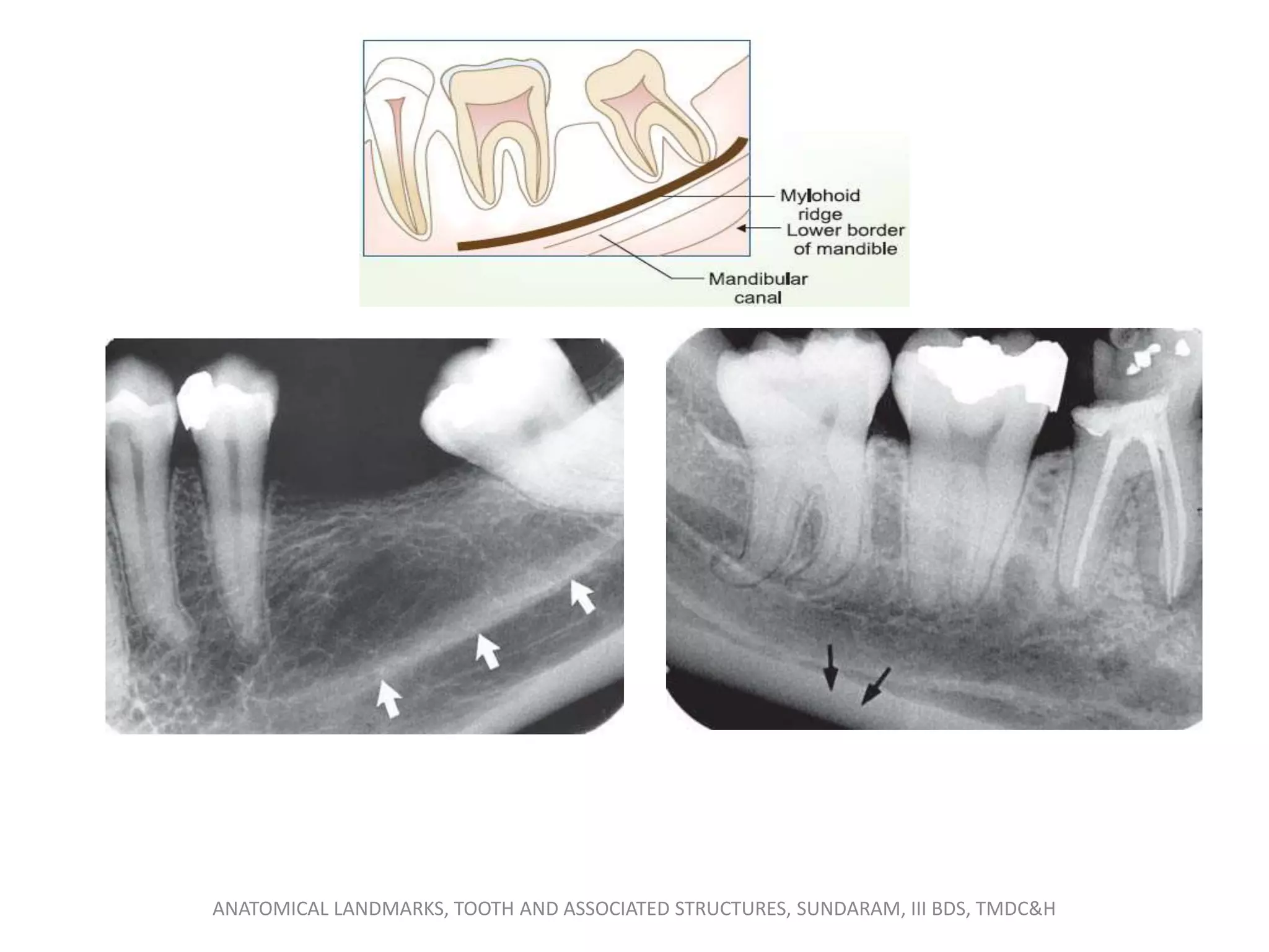 Anatomic landmarks seen in a IOPA | PPTX