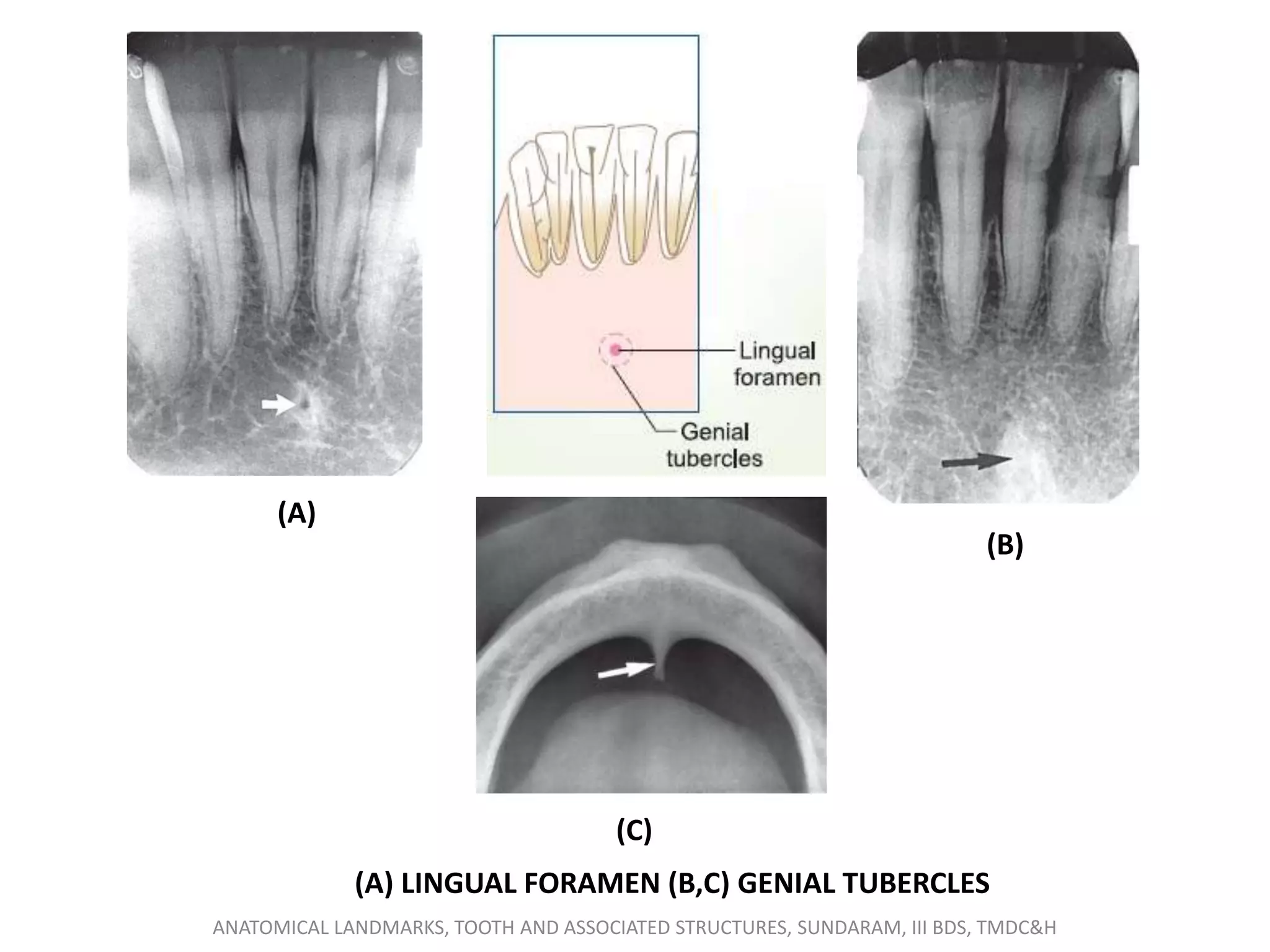 Anatomic landmarks seen in a IOPA | PPTX