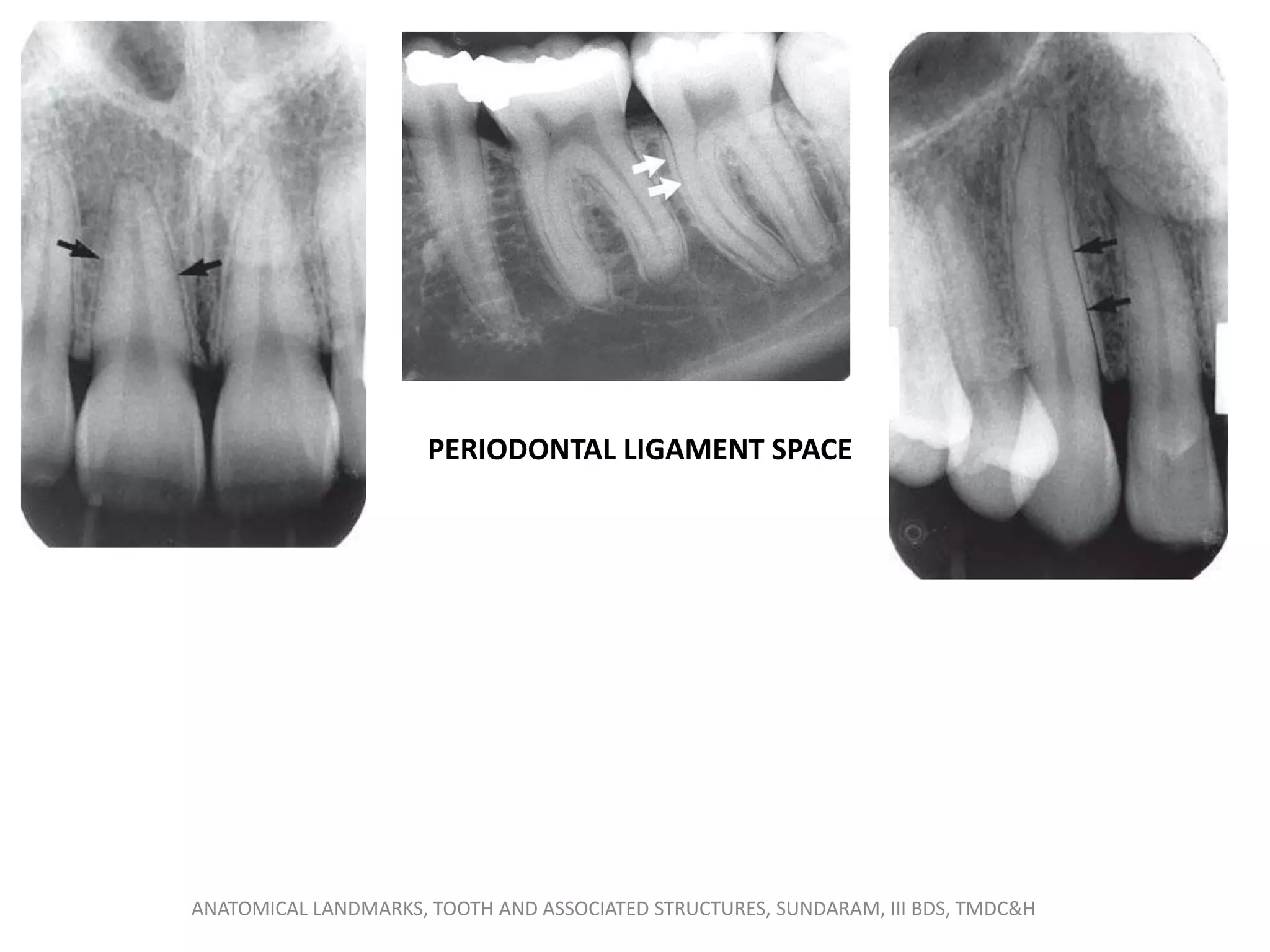 Anatomic landmarks seen in a IOPA | PPTX