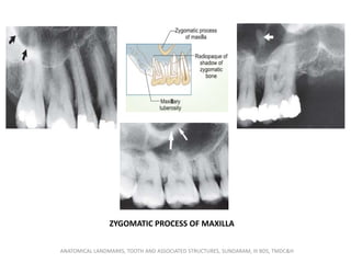Anatomic landmarks seen in a IOPA | PPTX