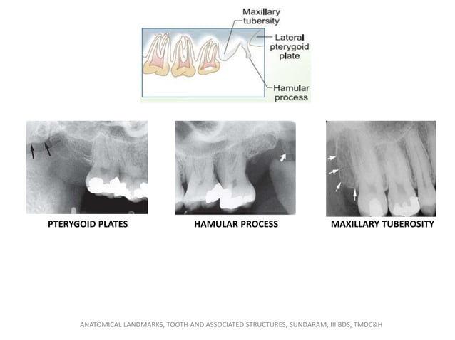 Anatomic landmarks seen in a IOPA | PPTX