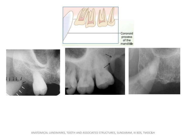 Anatomic landmarks seen in a IOPA | PPTX