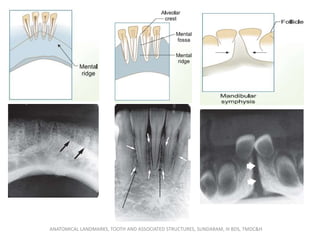 Anatomic landmarks seen in a IOPA | PPTX