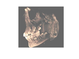 Anatomic landmarks seen in a IOPA | PPTX