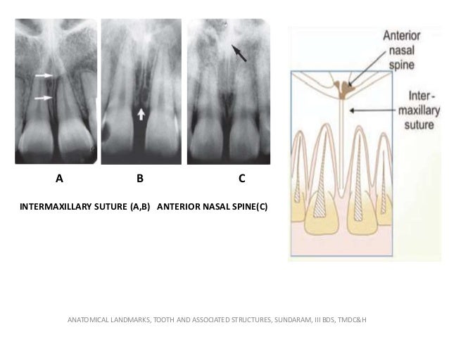 Anatomic landmarks seen in a IOPA