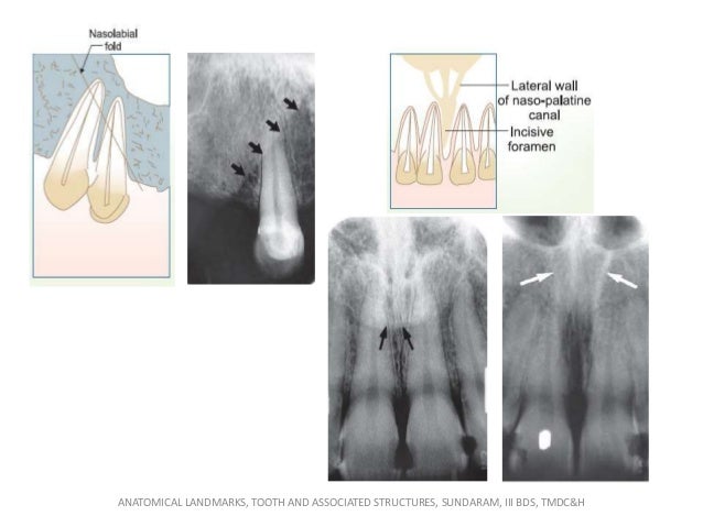 Anatomic landmarks seen in a IOPA