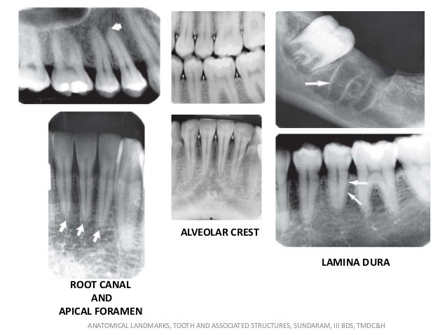 Anatomic landmarks seen in a IOPA