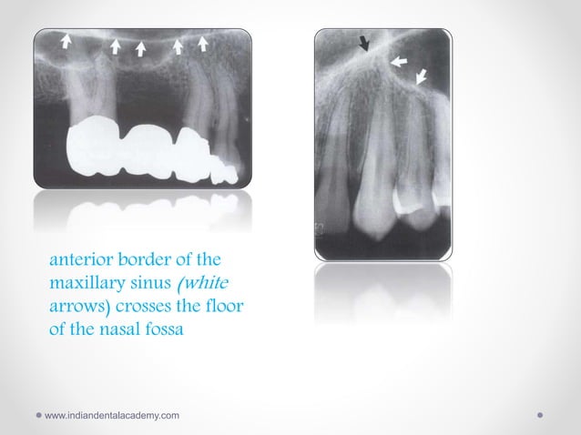 Anatomic radiopacities / dental implant courses | PPT