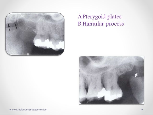 Hamular Process