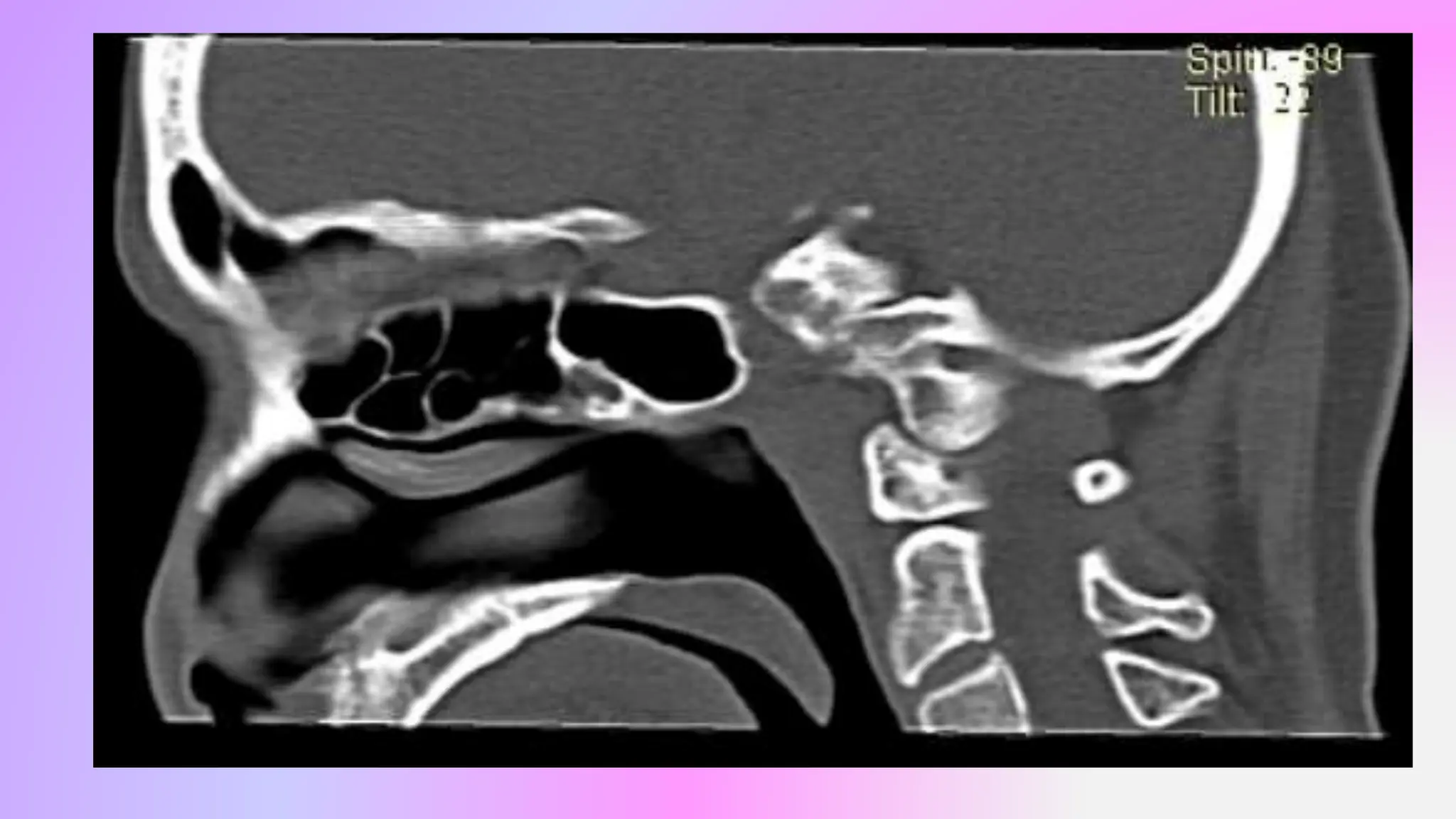anatomi based on CT scan sinus paranasal imaging | PPT
