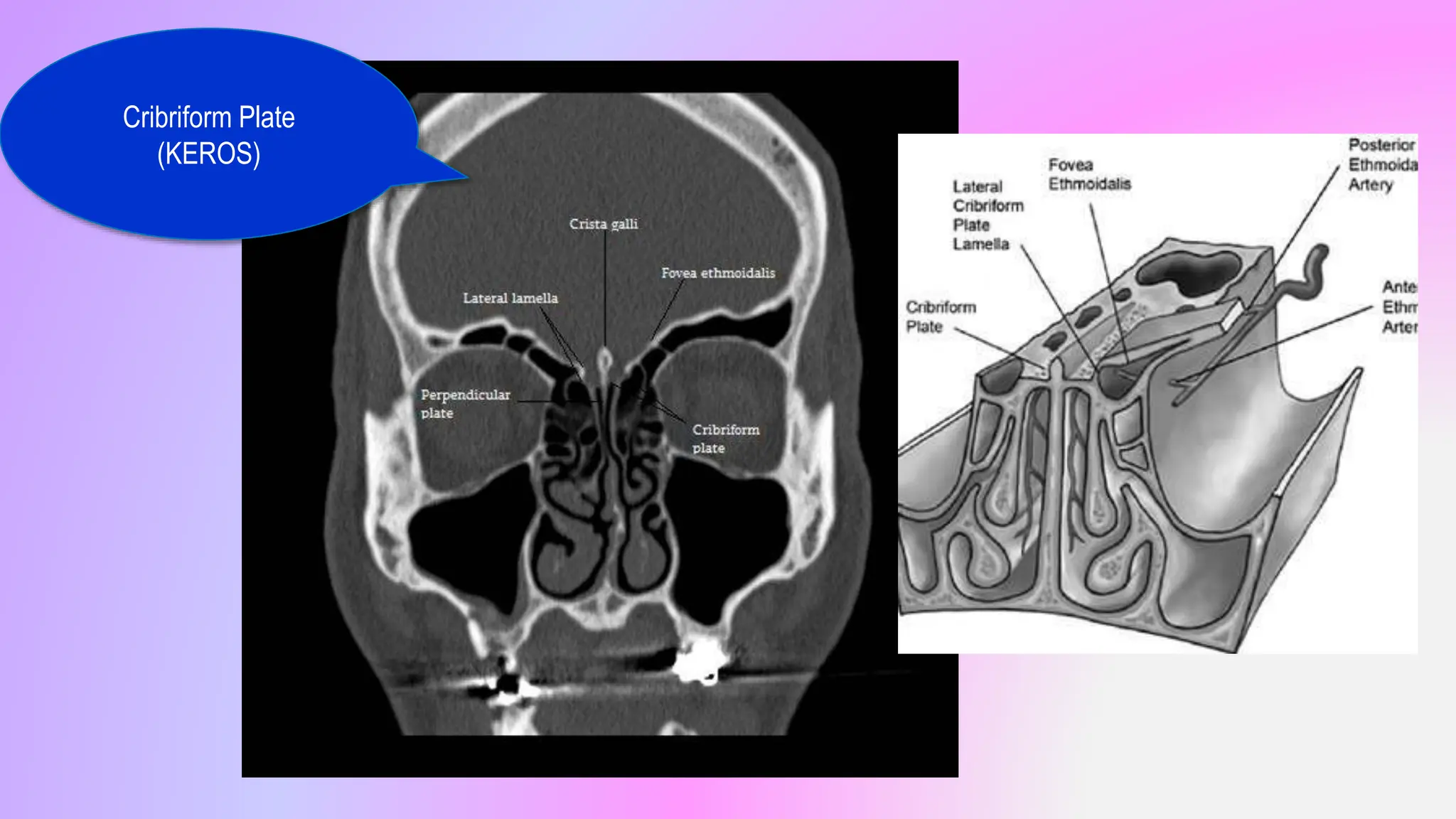anatomi based on CT scan sinus paranasal imaging | PPT