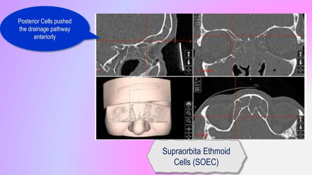 anatomi based on CT scan sinus paranasal imaging | PPT