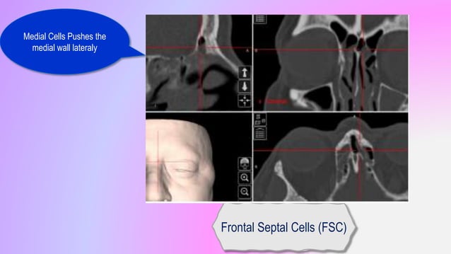 anatomi based on CT scan sinus paranasal imaging | PPT