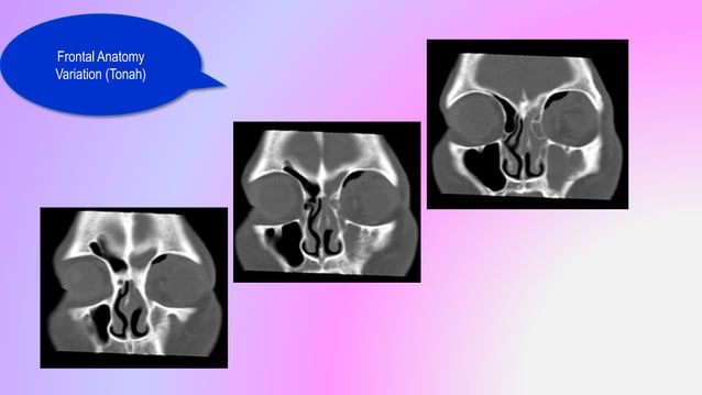 anatomi based on CT scan sinus paranasal imaging | PPT