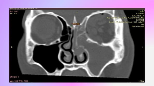 anatomi based on CT scan sinus paranasal imaging | PPT