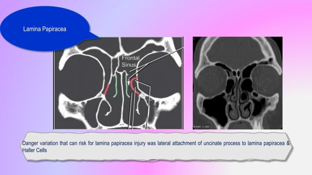anatomi based on CT scan sinus paranasal imaging | PPT