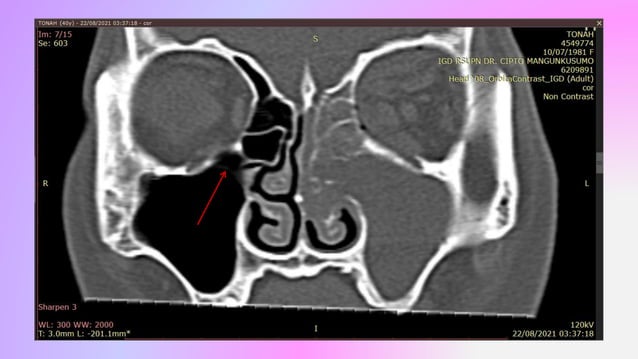 anatomi based on CT scan sinus paranasal imaging | PPT