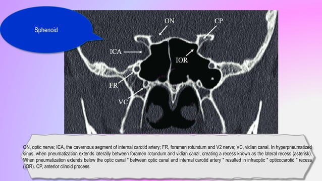 anatomi based on CT scan sinus paranasal imaging | PPT
