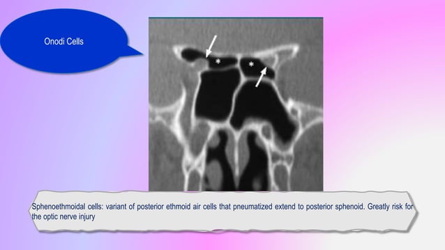 anatomi based on CT scan sinus paranasal imaging | PPT