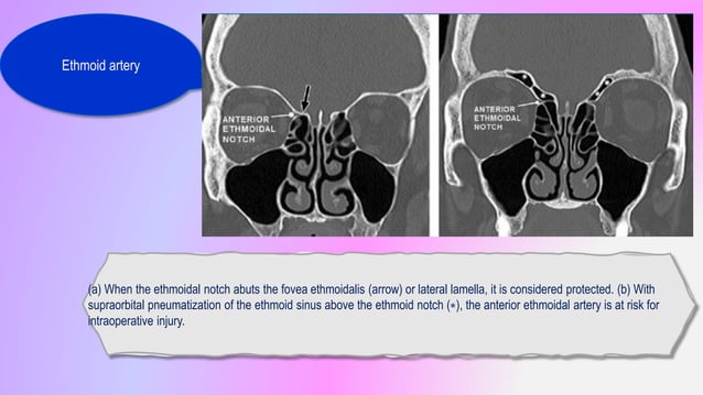 anatomi based on CT scan sinus paranasal imaging | PPT