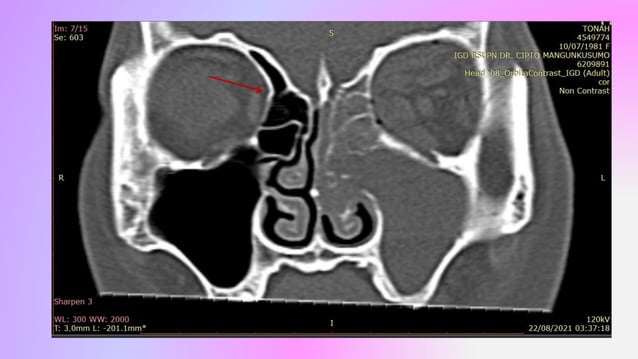 anatomi based on CT scan sinus paranasal imaging | PPT