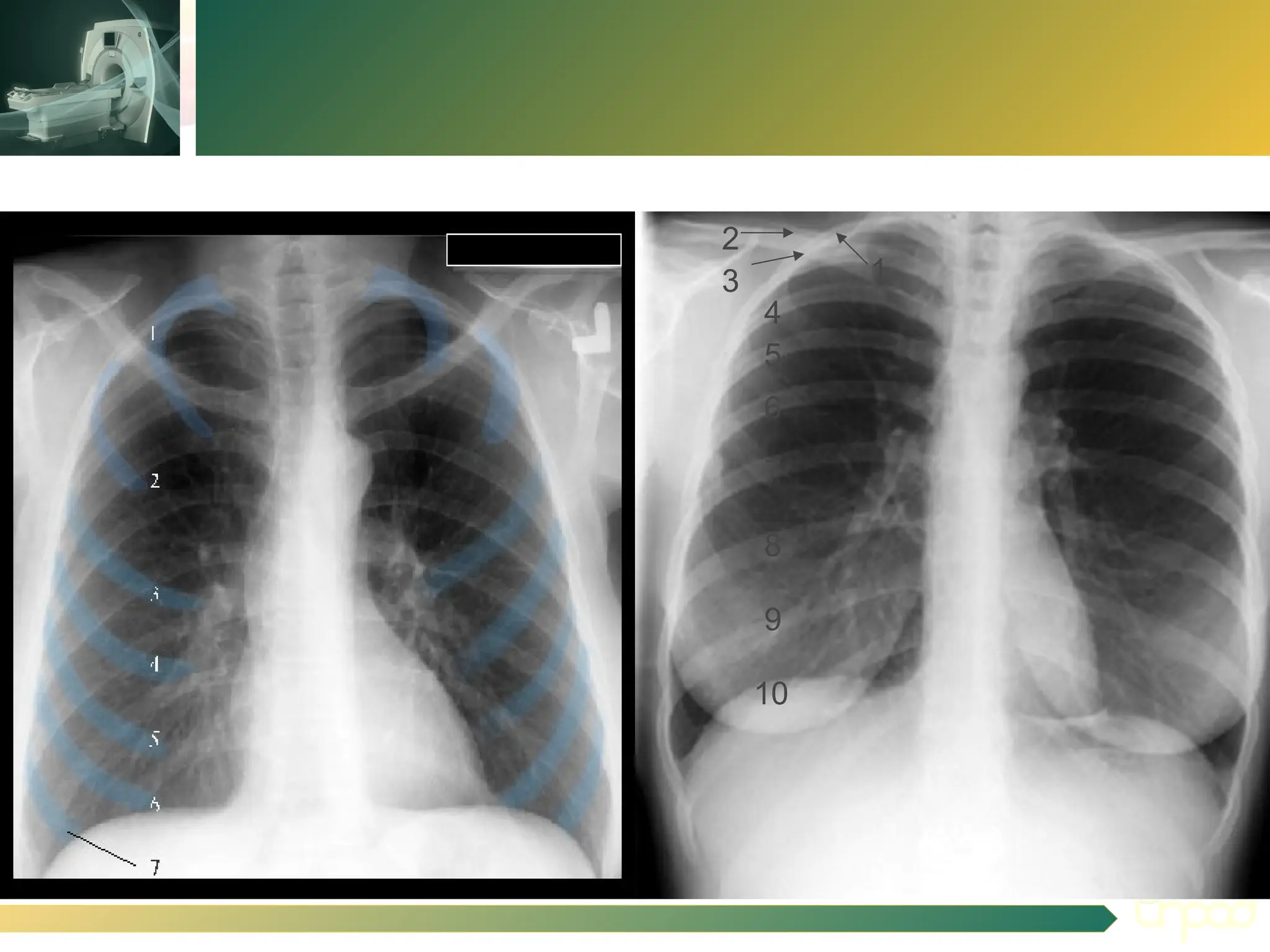ANATOMI THORAKS Basic for Radiologi.pptx