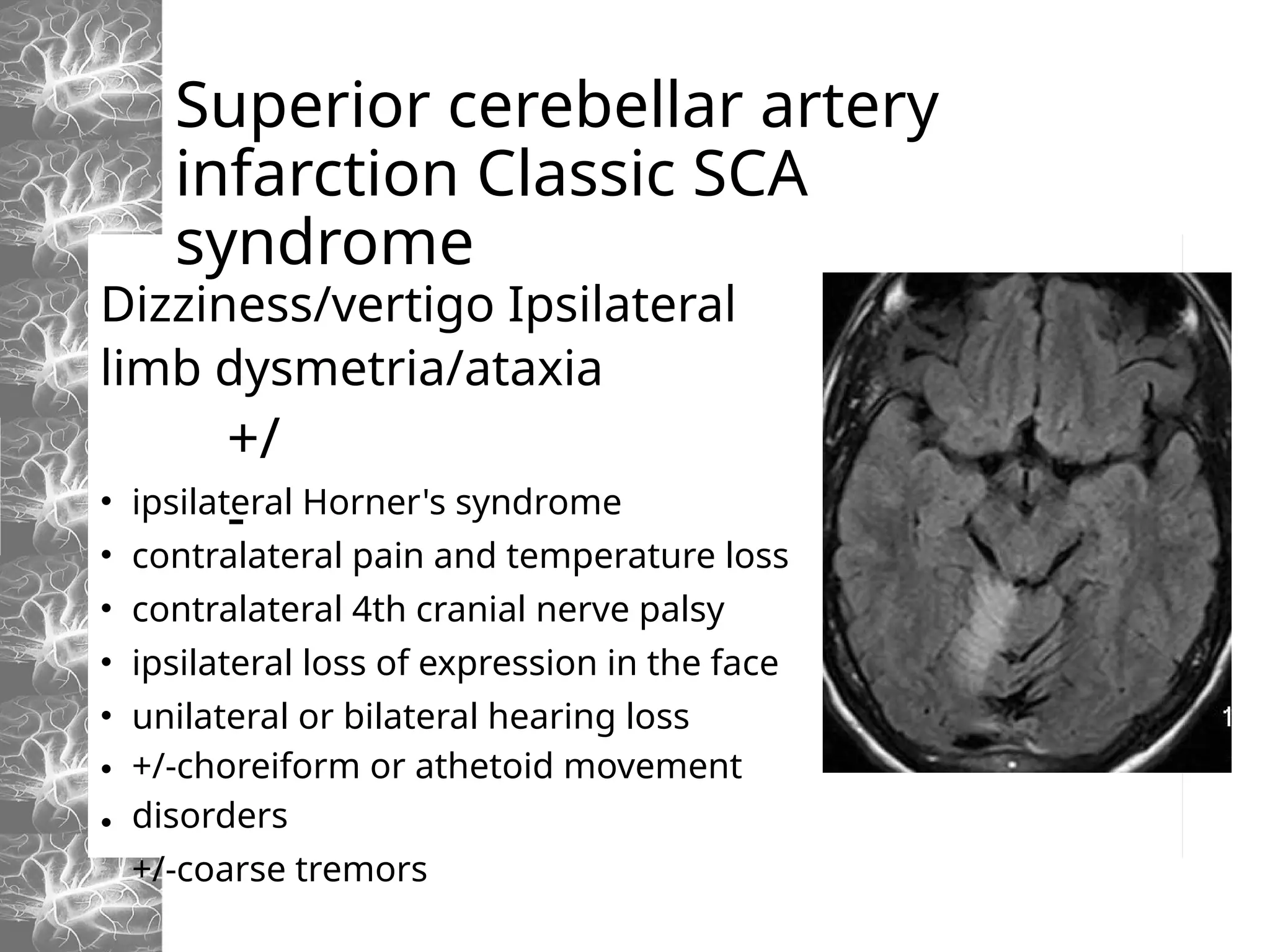 Anatomi Vertebrobasiler dan Posterior Cerebral Artery - Fajar.pptx