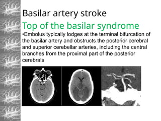 Anatomi Vertebrobasiler dan Posterior Cerebral Artery - Fajar.pptx