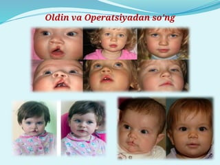 Anatomiya Lab-tanglay anomaliyasi. Ularda kuzatiladigan patologiyalar | PPT