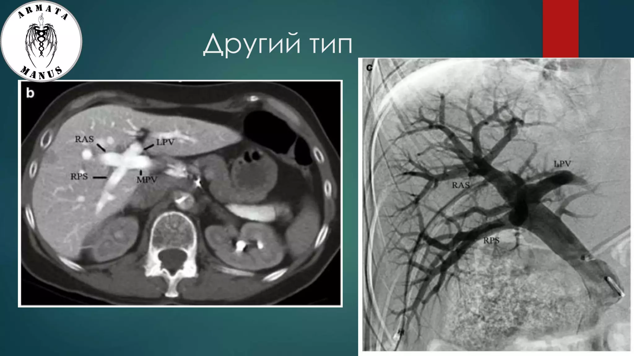 Anatomy of liver hilum | PPTX