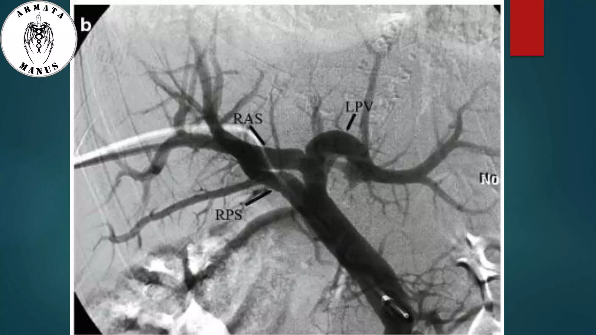 Anatomy of liver hilum | PPTX
