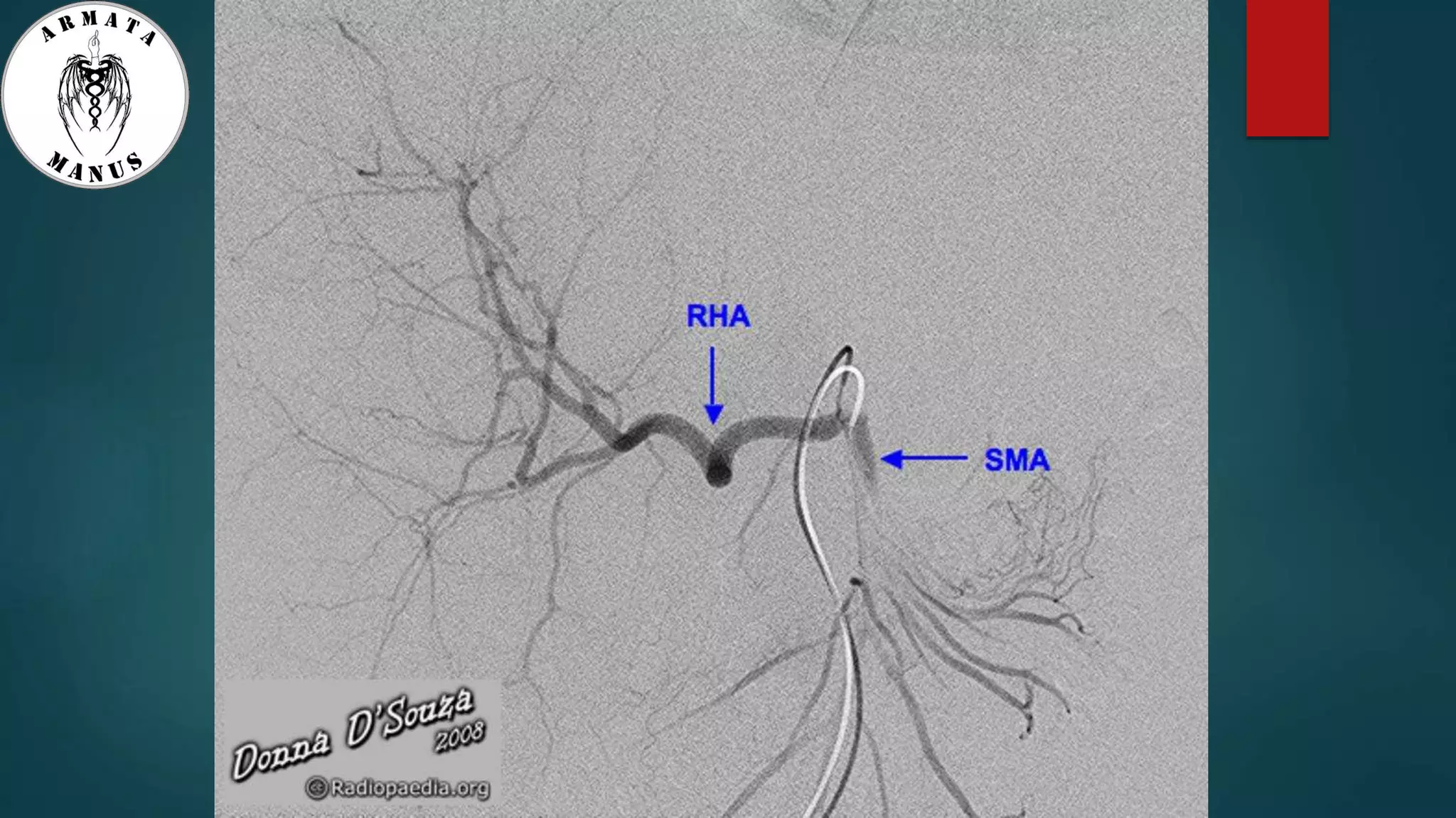 Anatomy of liver hilum | PPTX
