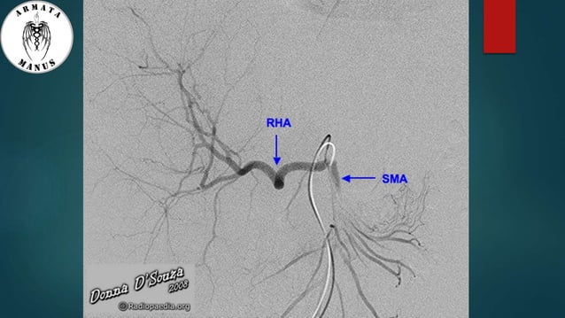 Anatomy of liver hilum | PPTX