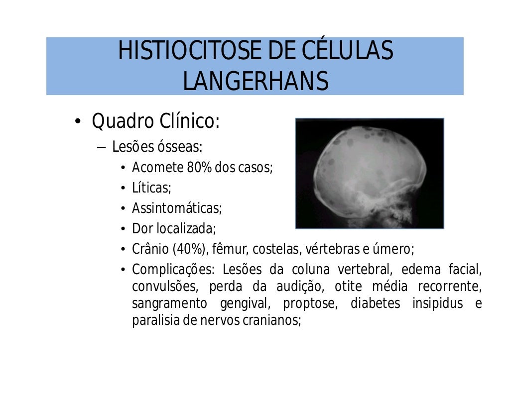 Histiocitose de Células de Langerhans