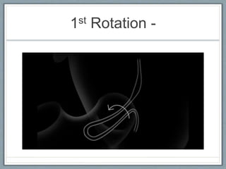 Rotation of gut | PPTX