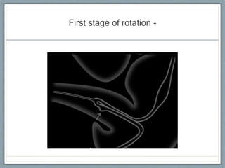 Rotation of gut | PPTX