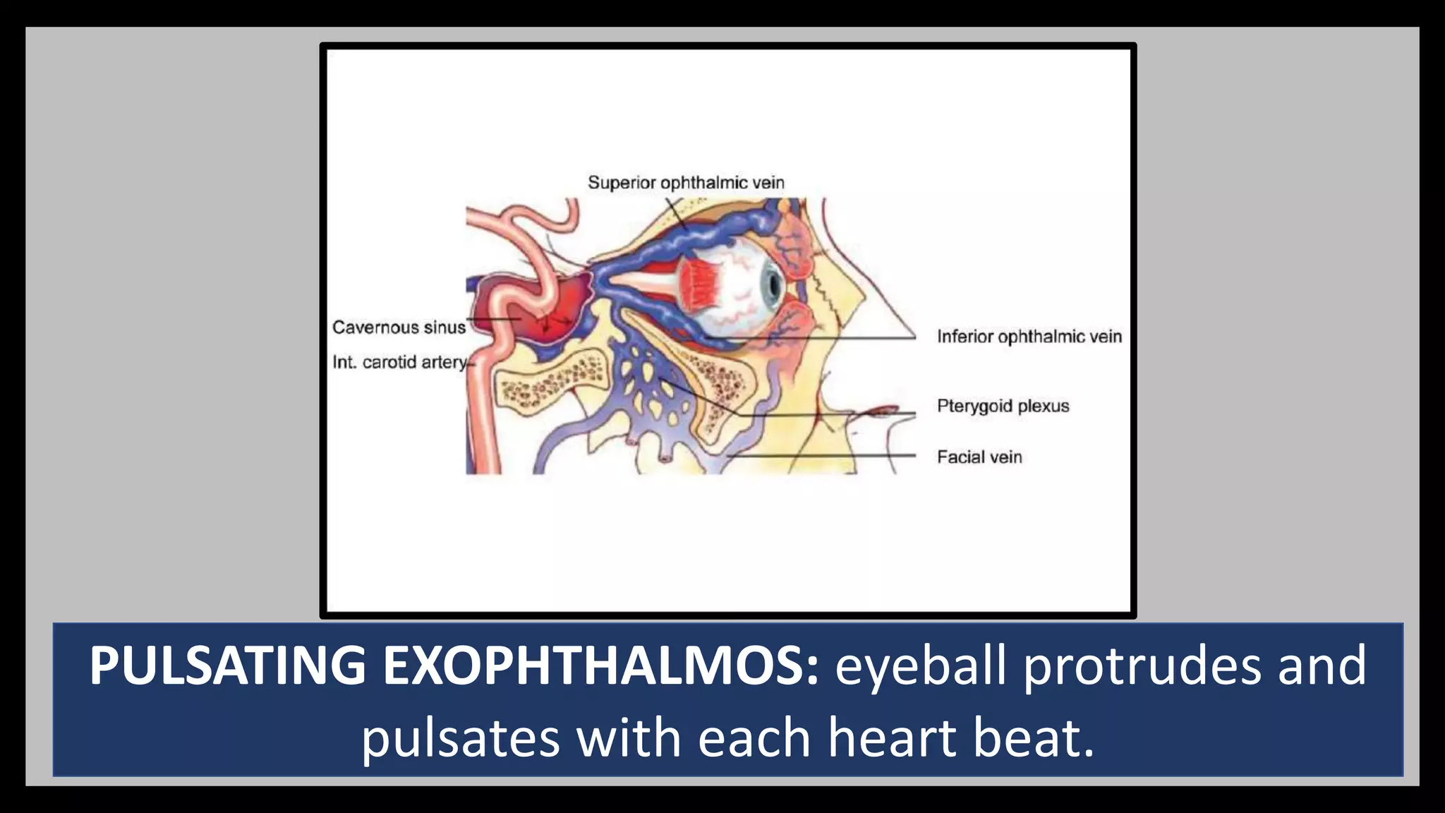 venous dural sinuses and cavenous venous sinus | PPT