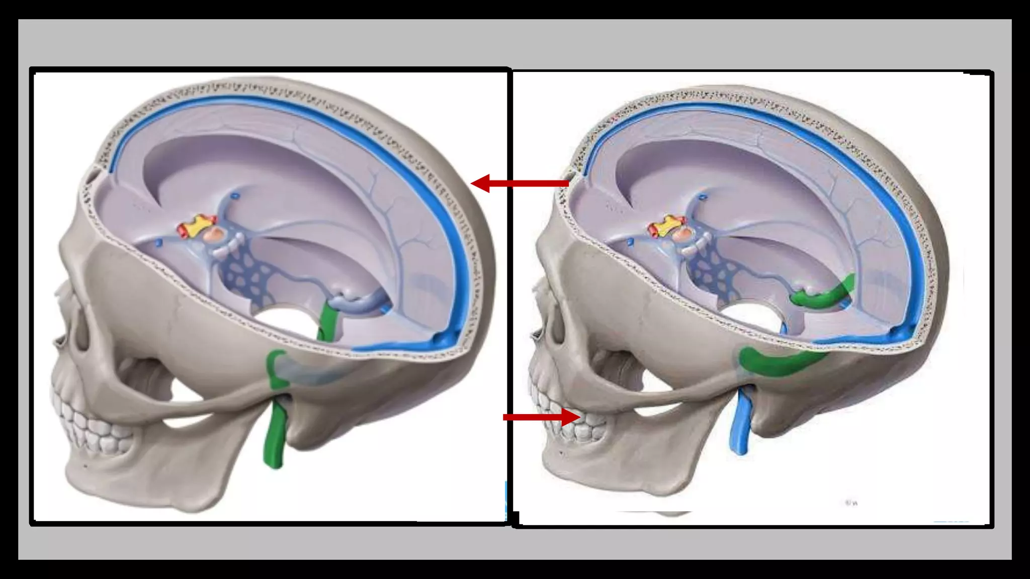 venous dural sinuses and cavenous venous sinus | PPT