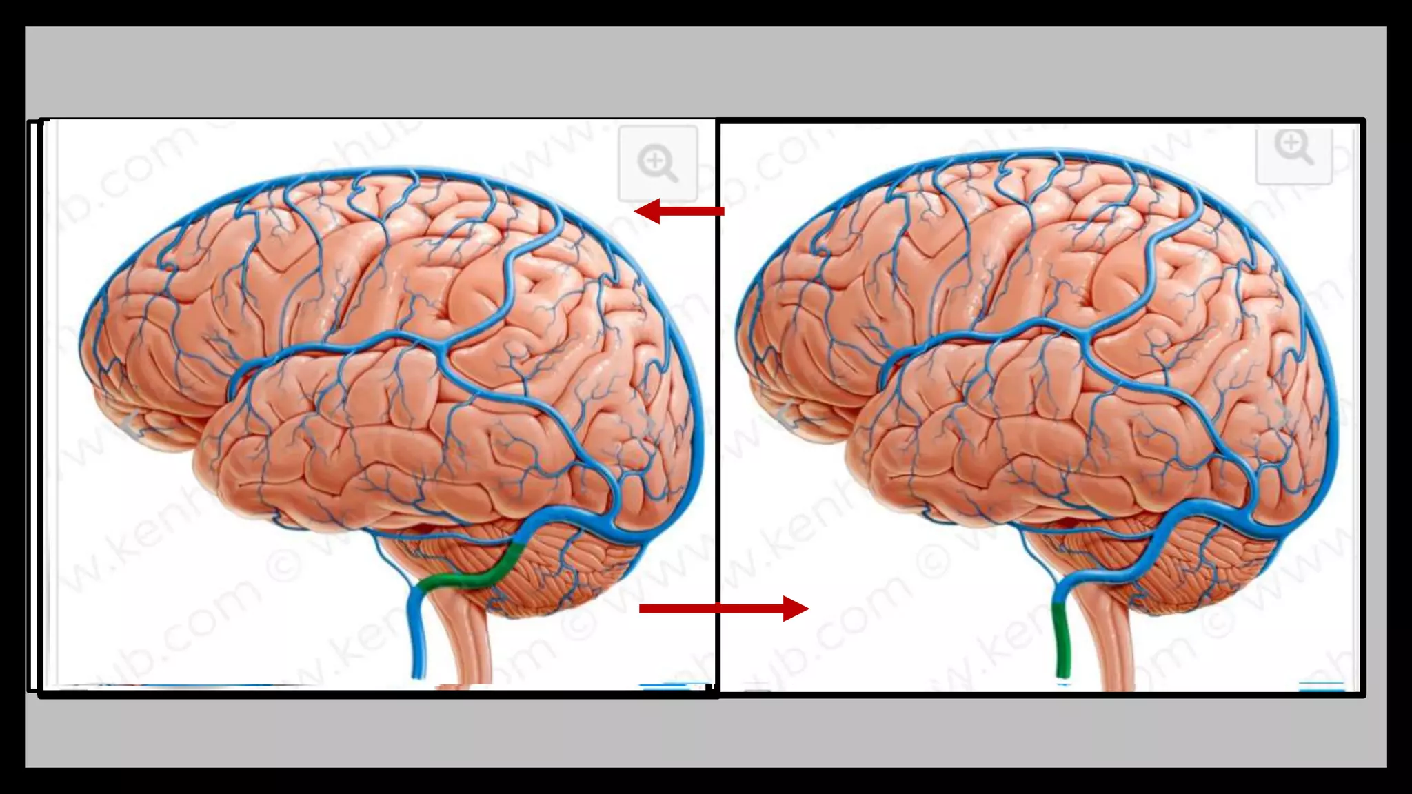 venous dural sinuses and cavenous venous sinus | PPT