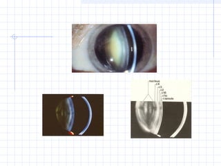 Anatomy of Lens : Ophthalmology | PPT