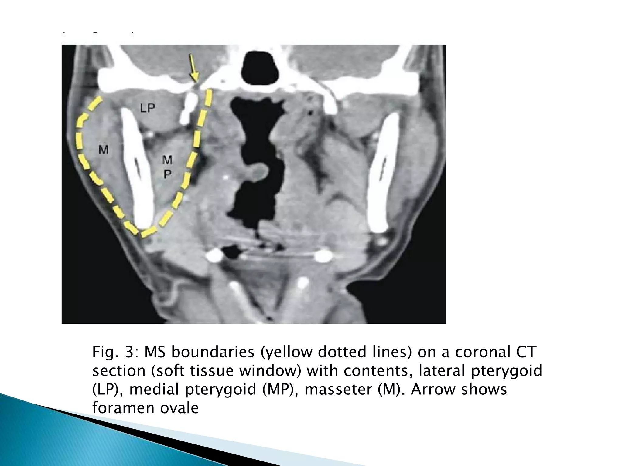 Radiological anatomy of infra temporal fossa | PPTX