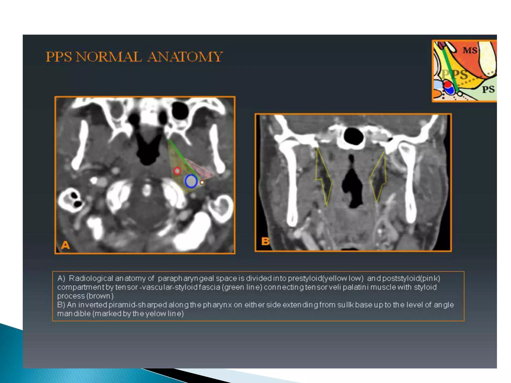 Radiological anatomy of infra temporal fossa | PPTX