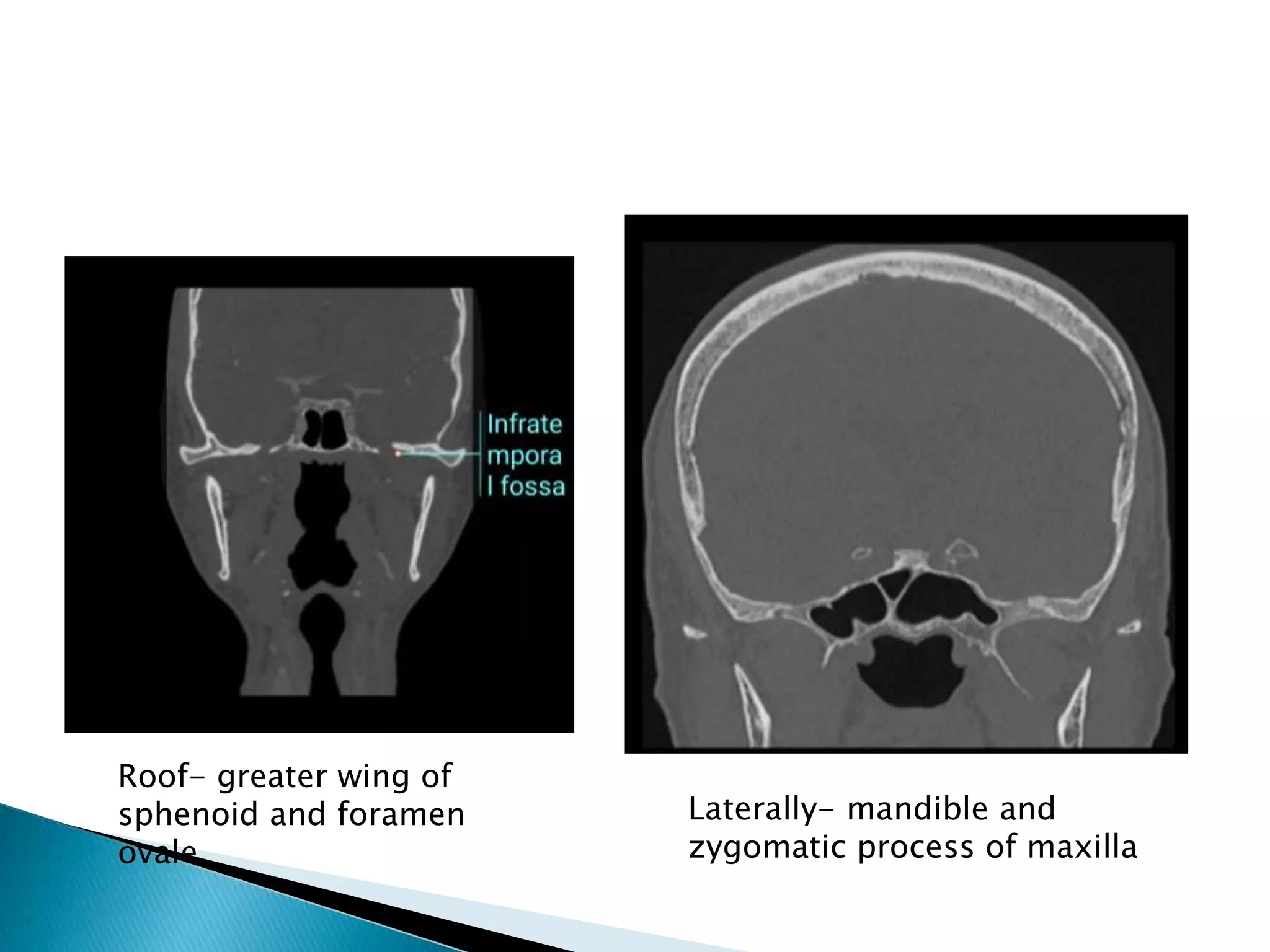 Temporal Fossa Radiology