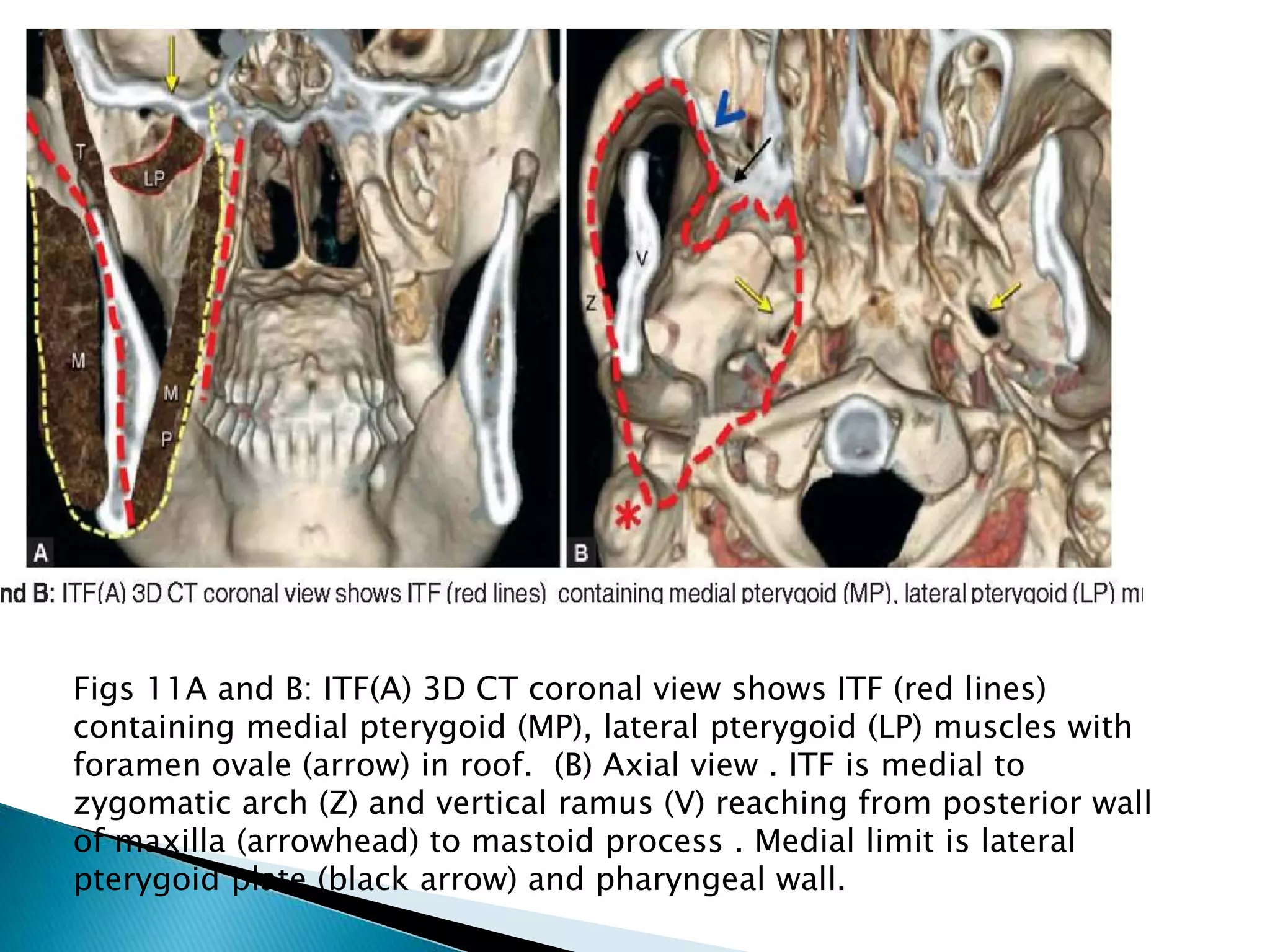 Radiological anatomy of infra temporal fossa | PPTX