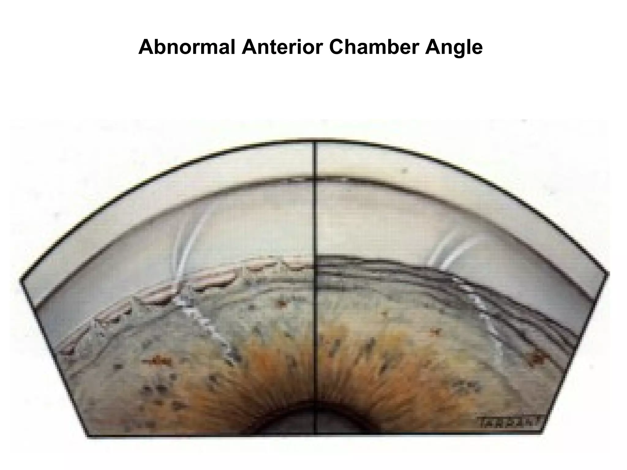 Anatomy of the angle structure (glaucoma) | PPT