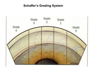 Anatomy of the angle structure (glaucoma) | PPT