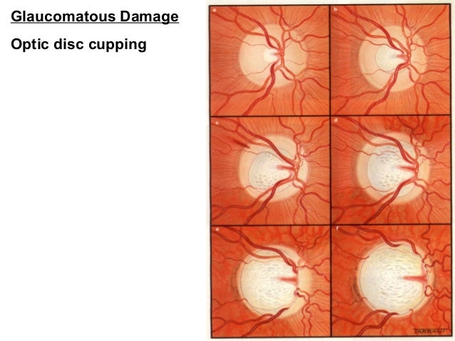 Anatomy of the angle structure (glaucoma)