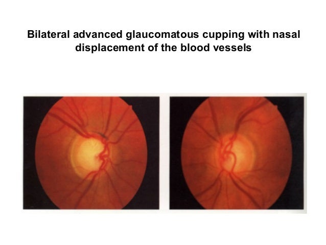 Anatomy of the angle structure (glaucoma)