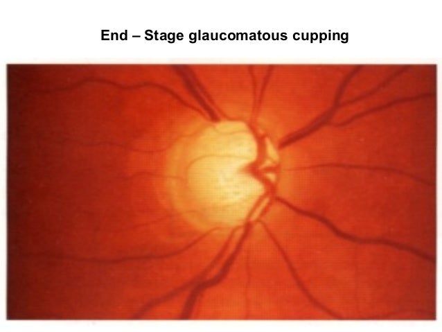 Anatomy of the angle structure (glaucoma)