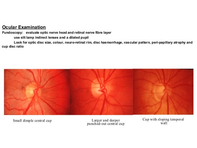 Anatomy of the angle structure (glaucoma)